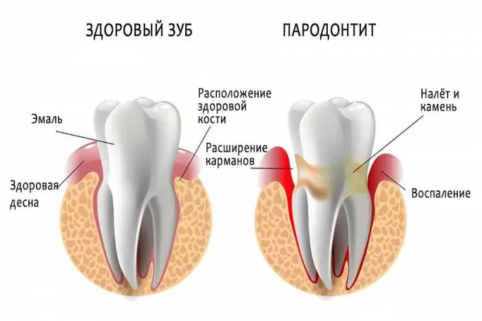 Parodontitis na diagramu