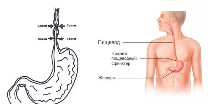 Спазъм на хранопровода