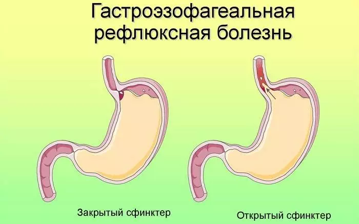 Errefluxu gastroesofagikoaren gaixotasuna (ERGE)