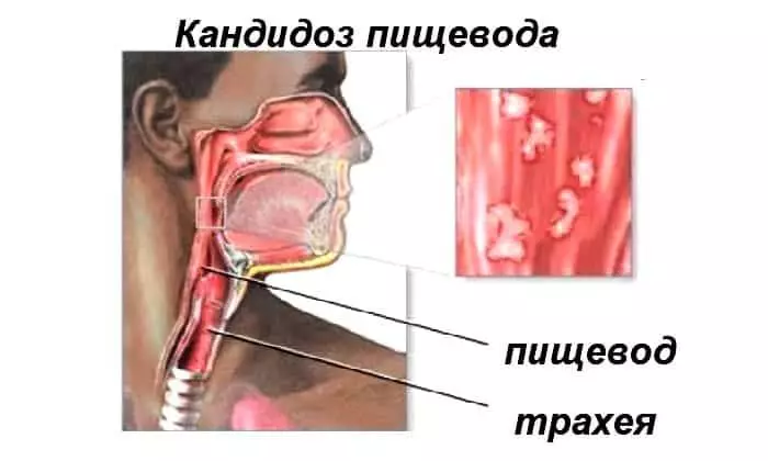 Esophageal candidiasis