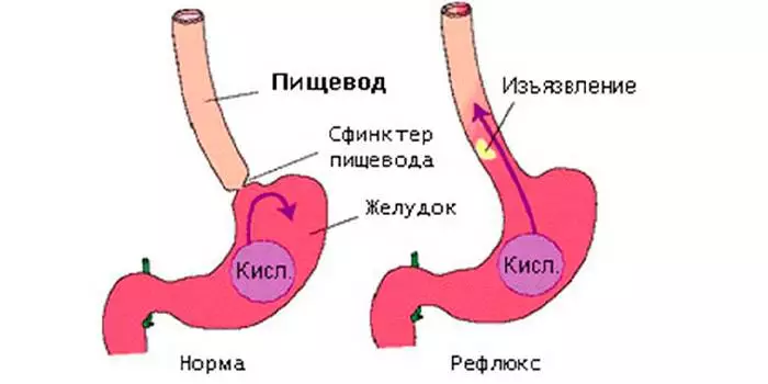 რეფლუქს ეზოფაგიტი