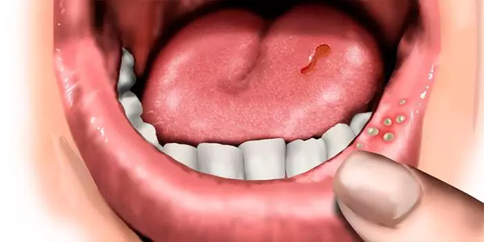 Stomatitis v ustih