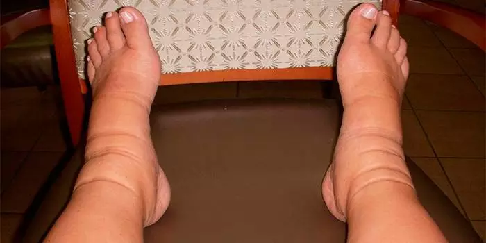 Zwelling van de benen