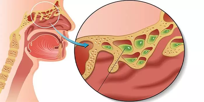 Sinusitis