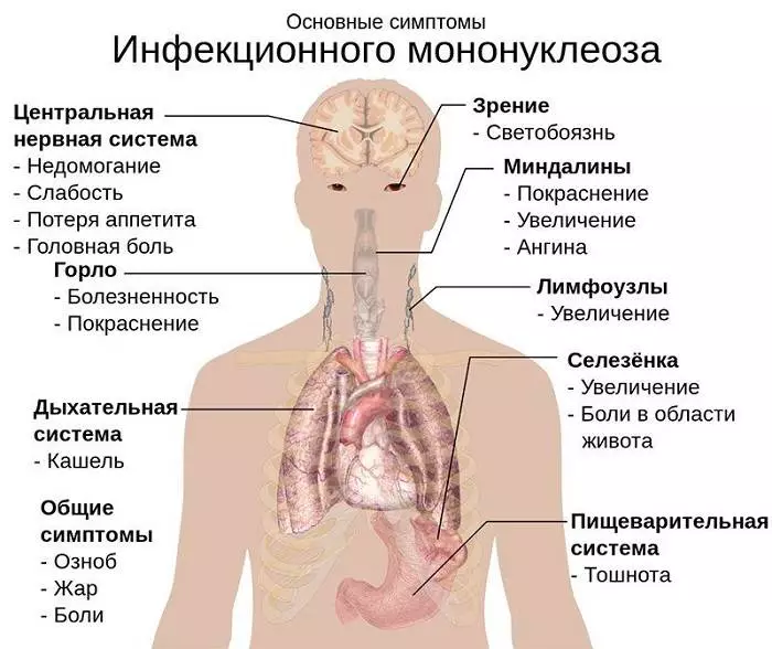 د مونوکلیوسیس نښې