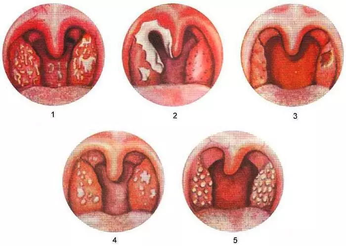 Infezione alla gola