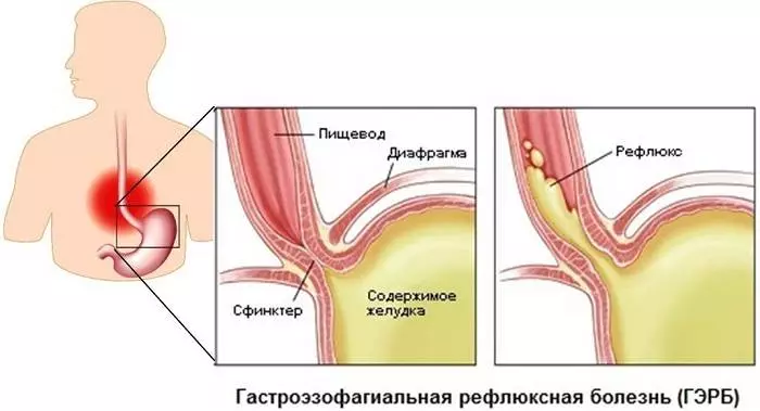 Aretina reflux