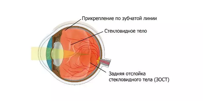 ניתוק גוף הזגוגית בתרשים