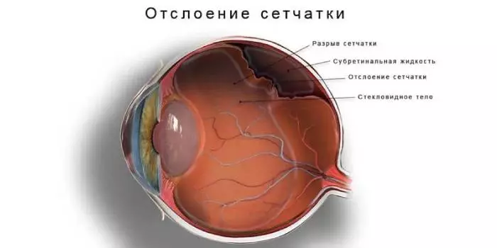 Retinal detachment