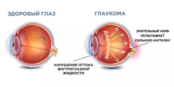 I-glaucoma