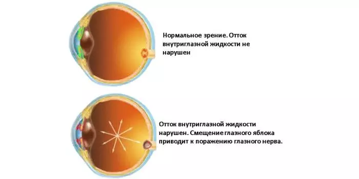 Damage to the optic nerve