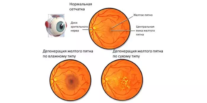 Dejenerasyona corpus luteumê ya çavê