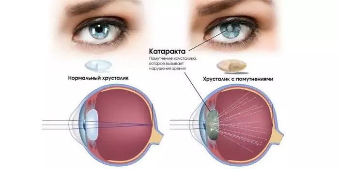 Cataract