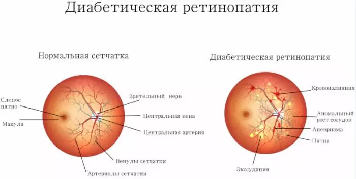 I-retinopathy yesifo sikashukela