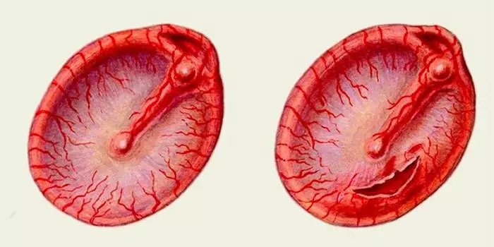 Microcracks of the tympanic membrane with baratrauma