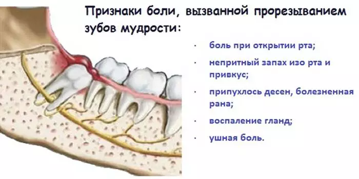 Signs of pain when erupting a wisdom tooth