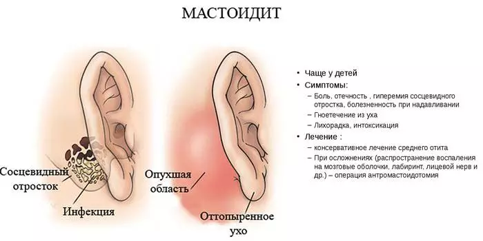 Príznaky a liečba mastoiditídy