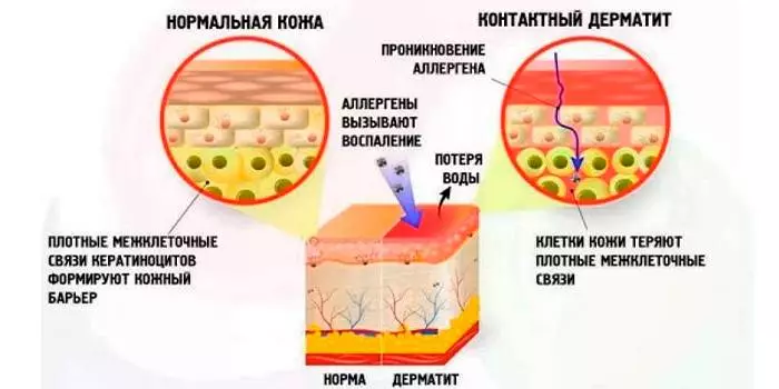 Hogyan alakul ki a kontakt dermatitis?