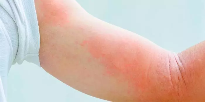 A bőr allergiájának megnyilvánulása