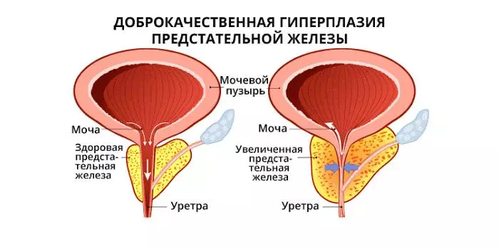 Hyperplasia of the prostate