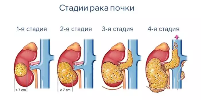 Stadier af nyrekræft