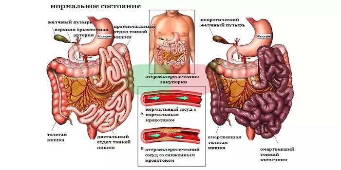 Isquemia intestinal no diagrama
