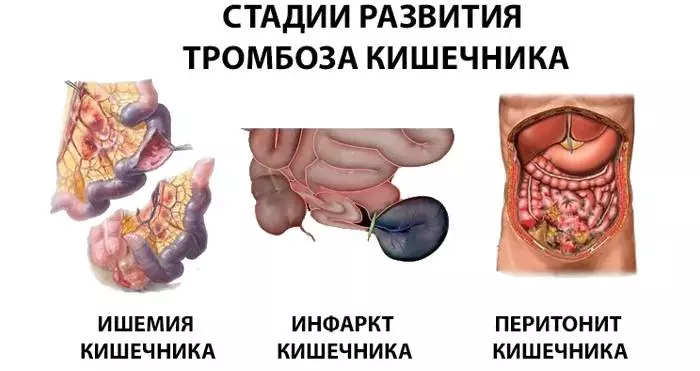 Фази на тромбоза на цревата