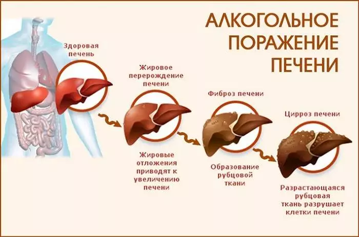 El efecto del alcohol en el hígado.