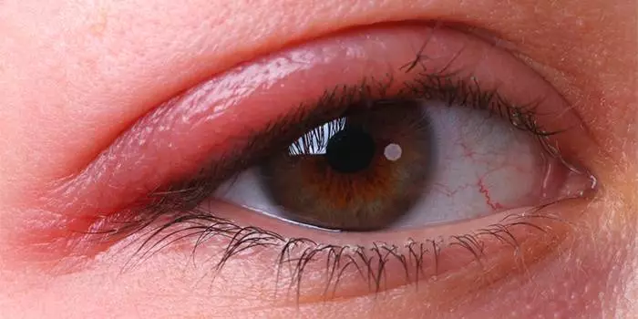 Swollen ooglid mei blefaritis