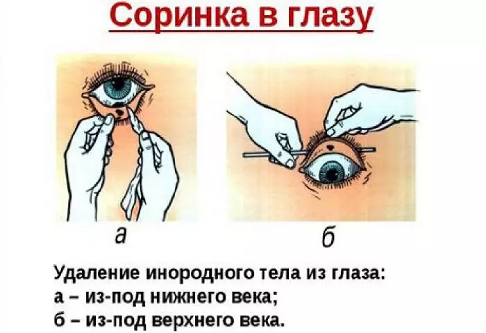 Ako odstrániť cudzie teleso z oka