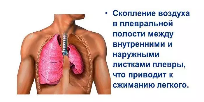 Odma płucna