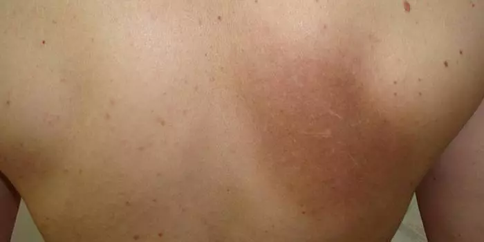 Melasma