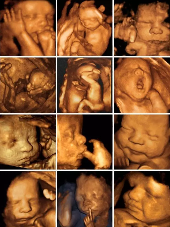 Foto del feto después de una ecografía tridimensional.