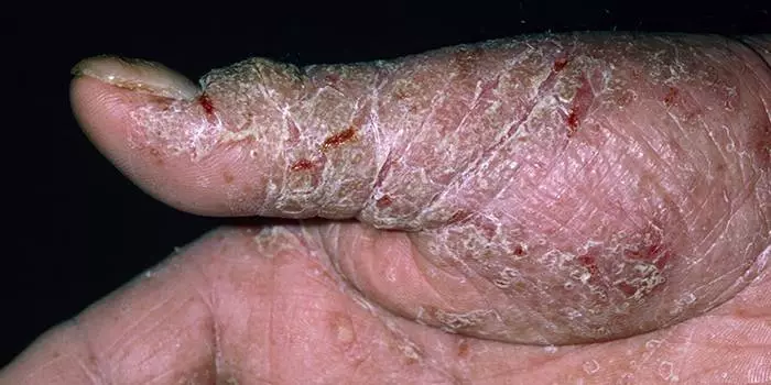 Eczema