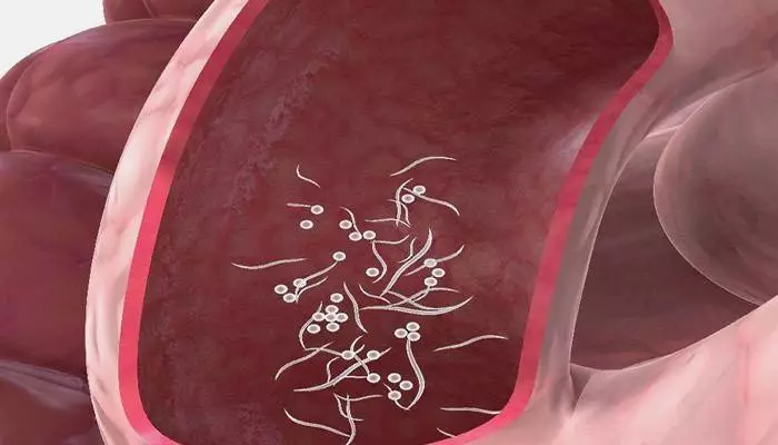 İnsan bağırsağında parazitlərin sxematik təsviri